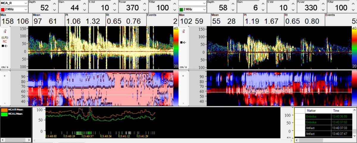 Transcranial Doppler (TCD) – UTHSC Neurosonology